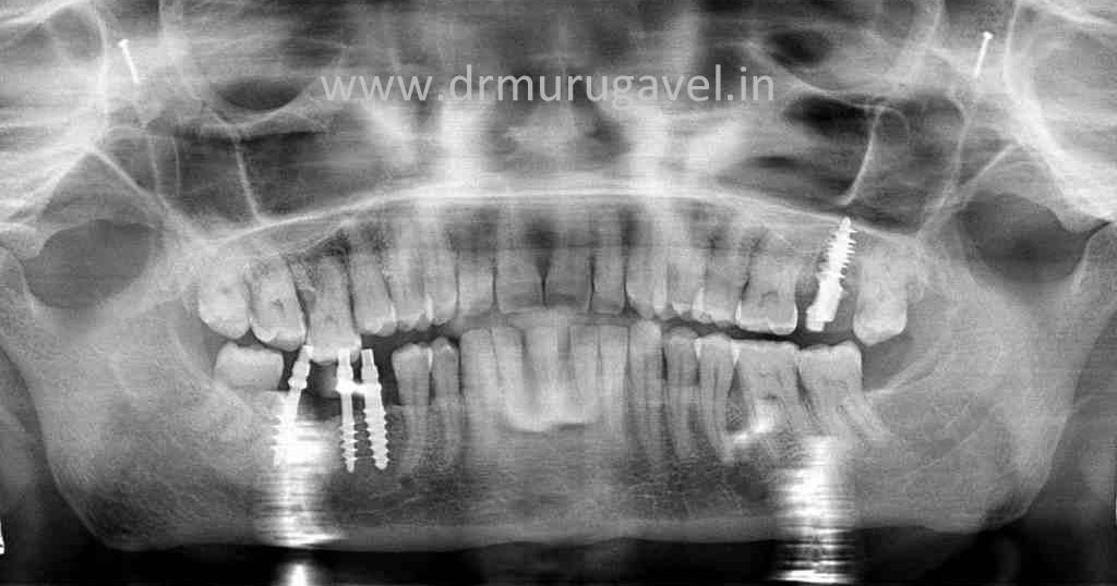 Basal Implants in chennai: Immediate loading basal dental implants in ...