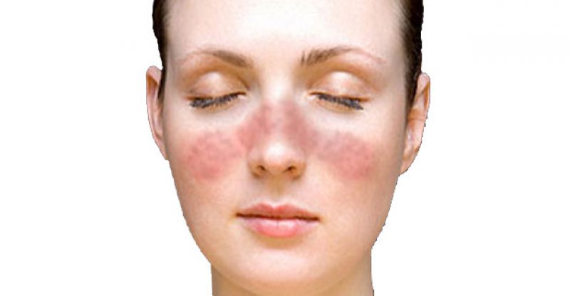 Neozen Estética: El Lupus, la importancia de cuidar la piel