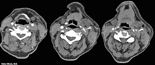 Roentgen Ray Reader: Penetrating Neck Injuries