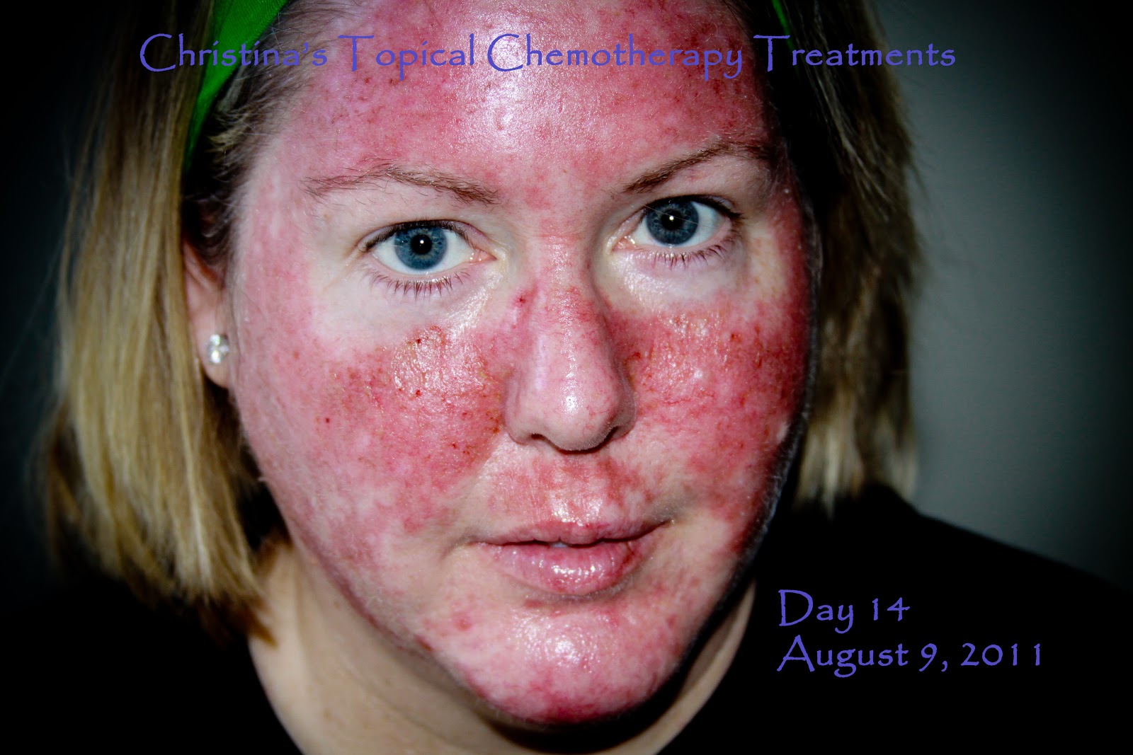 My Journey Through Topical Chemotherapy - Fluorouracil 5% Cream and ...