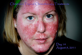 My Journey Through Topical Chemotherapy - Fluorouracil 5% Cream and ...