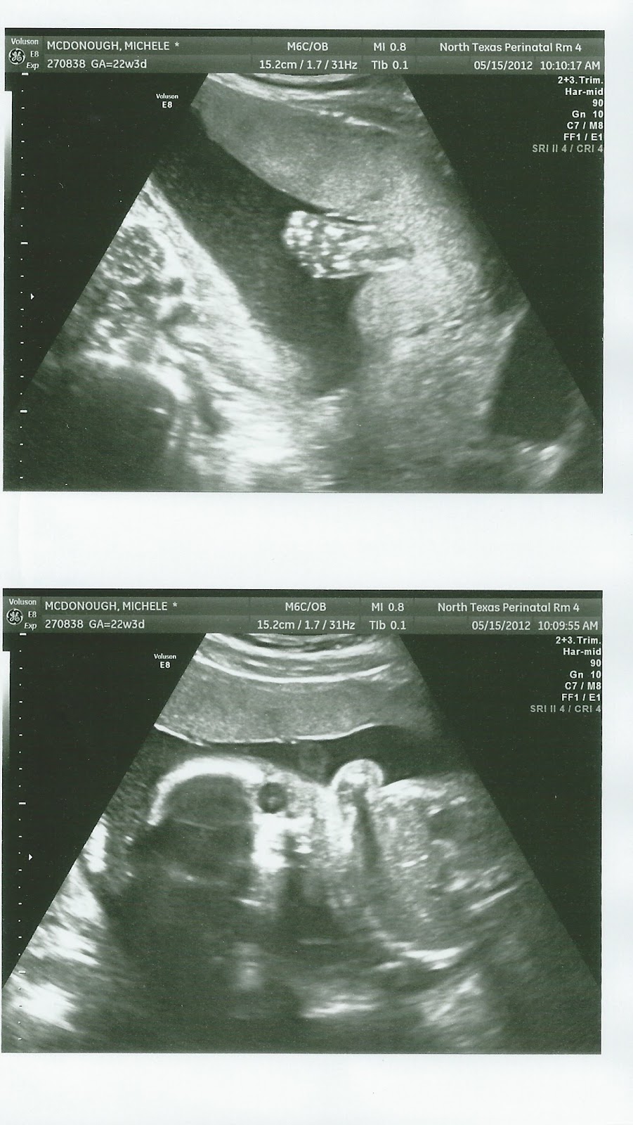 Daily Dimples: Baby M (22 weeks sonogram)