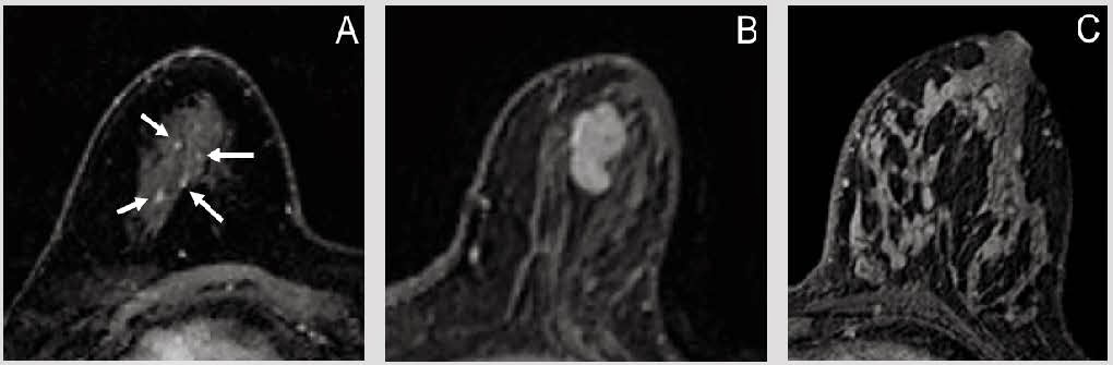 MRI and Medical Imaging: Magnetic Resonance Imaging of the Breast