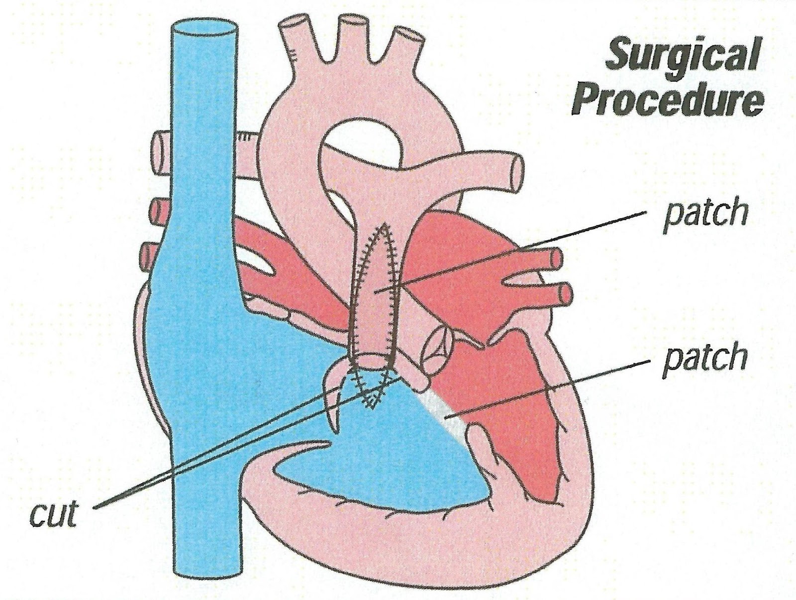 Matters of the Heart: What is Tetralogy of Fallot?