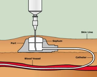 Enfermer@ en Urgencias y UCI : Técnica III: Reservorios subcutáneos.