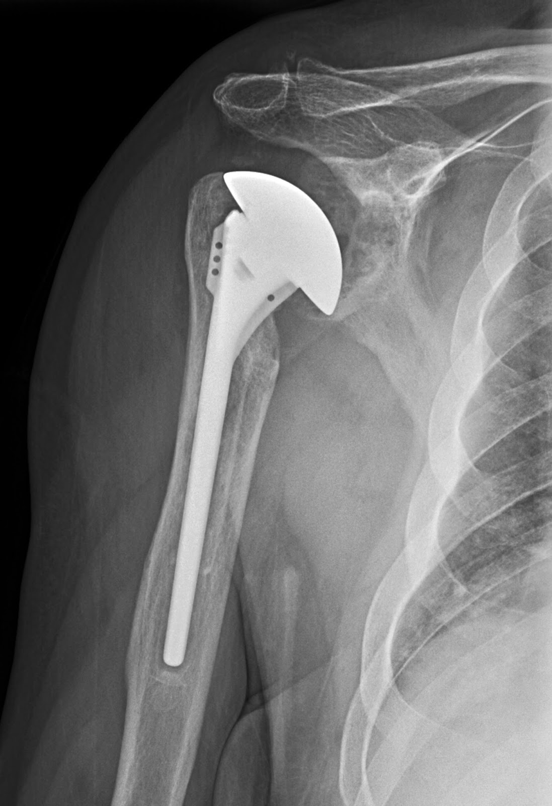 UW Shoulder and Elbow Academy: Loose glenoid component - is the ...