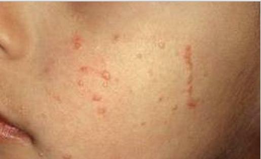 How To Remove Warts On Face - Moles, Warts & Skin Tags Removal