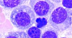 Polyclonal Gammopathy Symptoms, Causes, Treatment - Health Care Tips ...