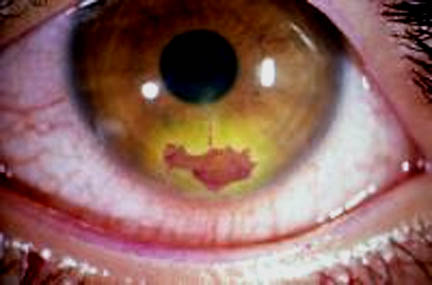 Photos For Herpes Simplex Keratitis (HSK) - Dendritic Corneal Ulcer ...