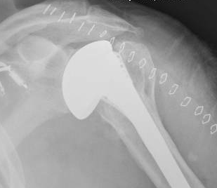 UW Shoulder and Elbow Academy: The humeral head component selection in ...