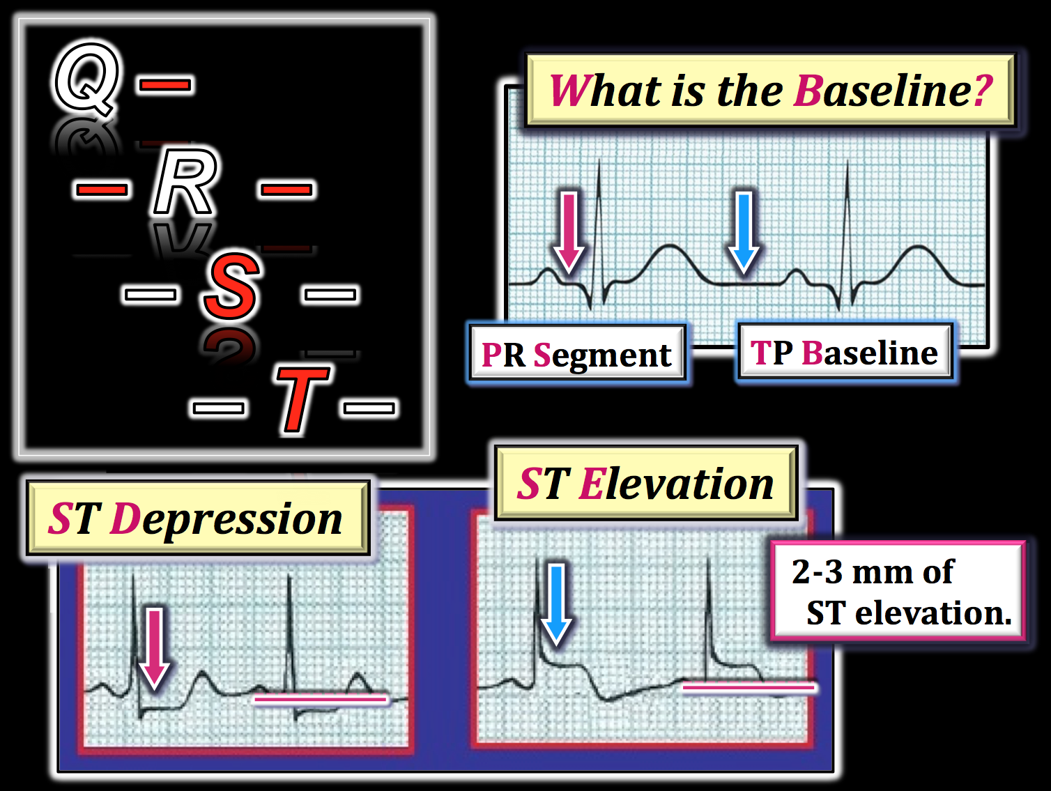 ECG Interpretation: September 2015
