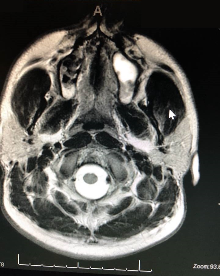 Maxillary Retention Cysts