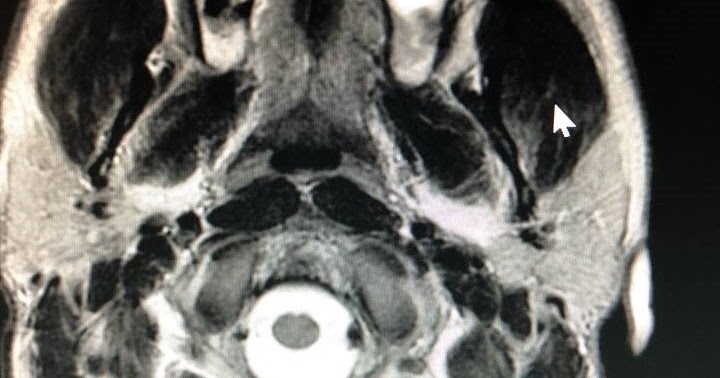 Maxillary Retention Cysts