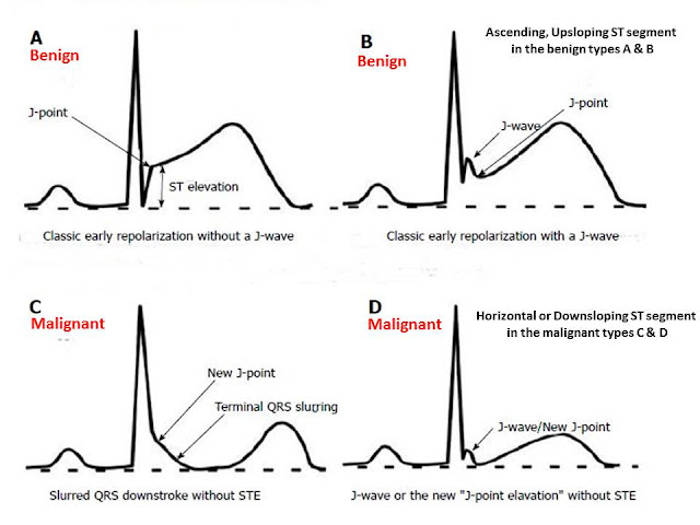 Pedi cardiology: Early Repolarization Patterns