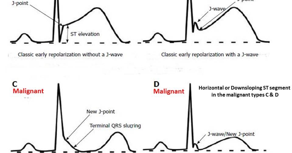 Pedi cardiology: Early Repolarization Patterns