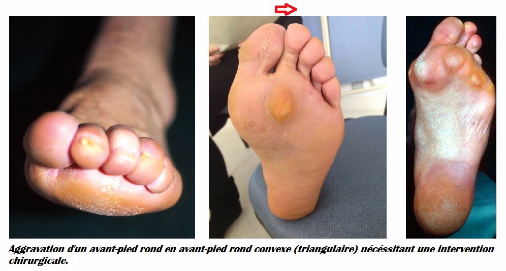 Cabinet Orthopédique Orthésiles Martinique: L’Avant-Pied Rond