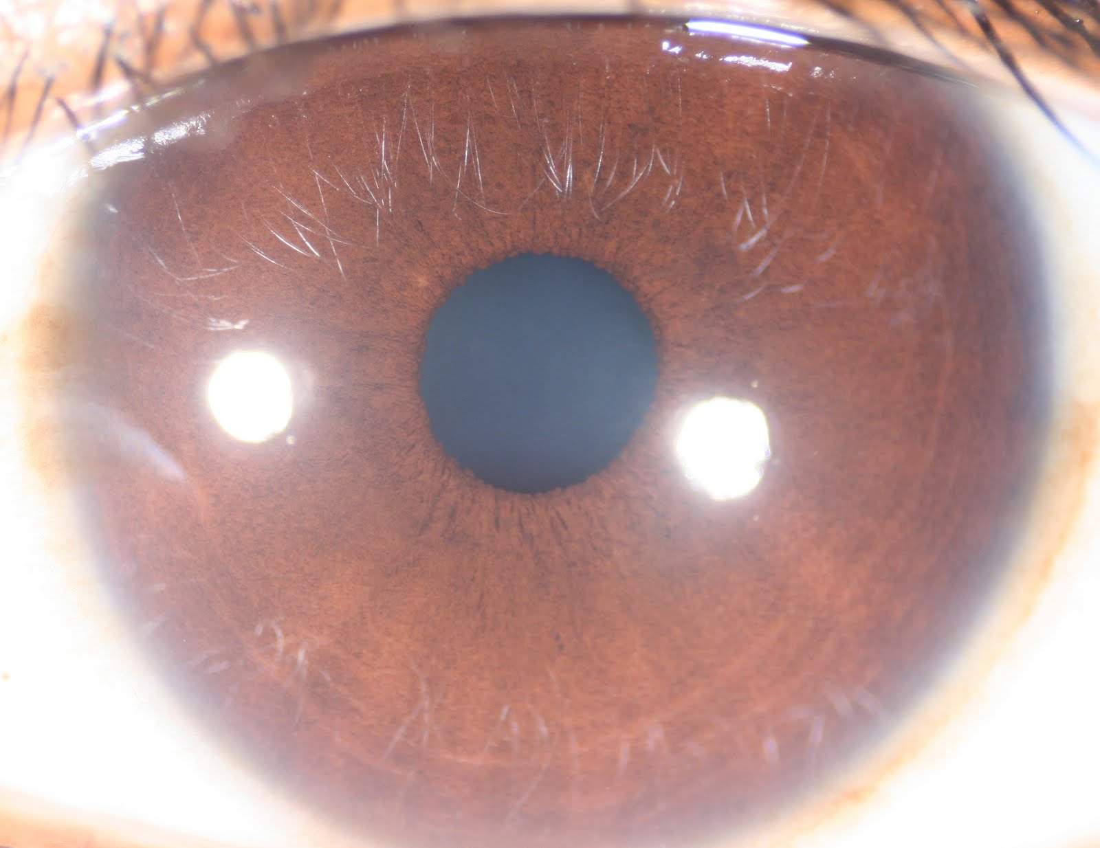 Modern & Multidimensional Iridology: Haematogenic Constitution/Pure ...