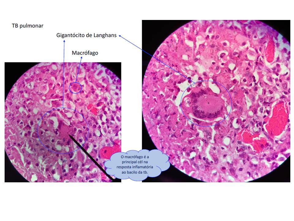 HISTOLOGIA90: TIPOS DE NECROSE