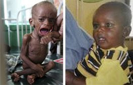 Conselho Tutelar de Lagoa Nova - RN: Bebê desnutrido que comoveu o ...