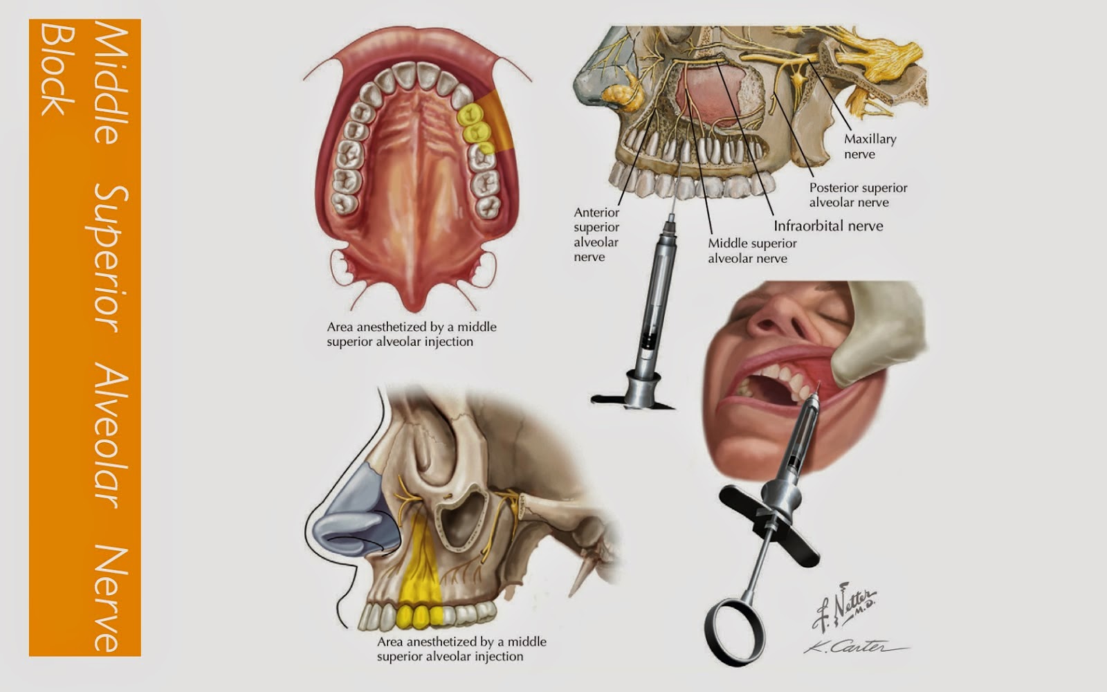 Maxillary Nerve Block Technique