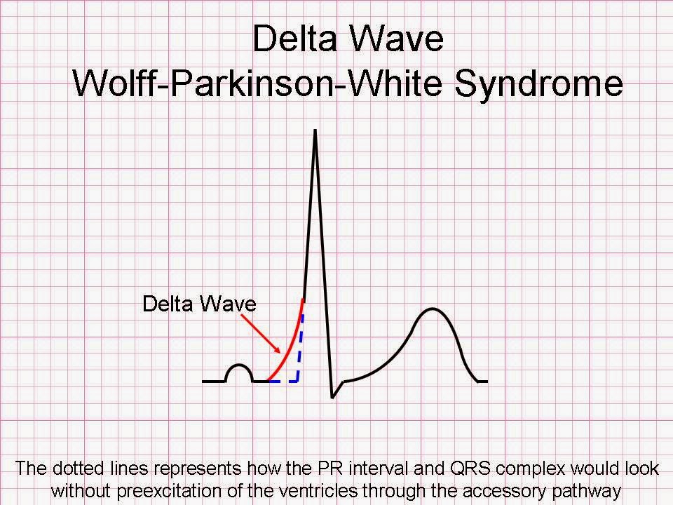 Sindrom Wolff-Parkinson-White | INA - ECG