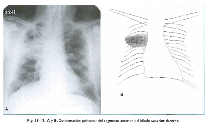 Síndromes Pleuropulmonares: Aprende su exploración física, a ...