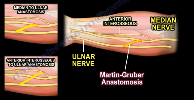 Dr. Nabil Ebraheim's Blogspot: Martin-Gruber Anastomosis