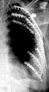 TITANIUM RIB PLATING: PHOTOS OF MY SURGERY & VIDEO