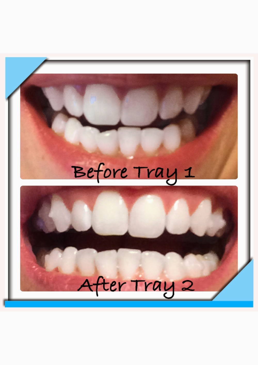 My Invisalign Journey: Tray 3 & Upper Attachment Nuisance Round 2!