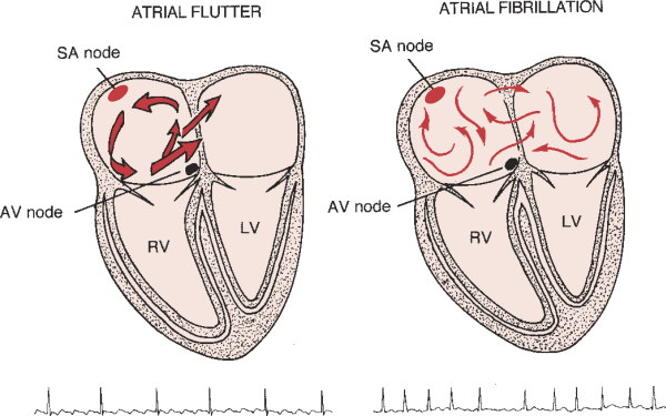 Kardioblog: (Podcast #9) Flutter versus Fibrilace