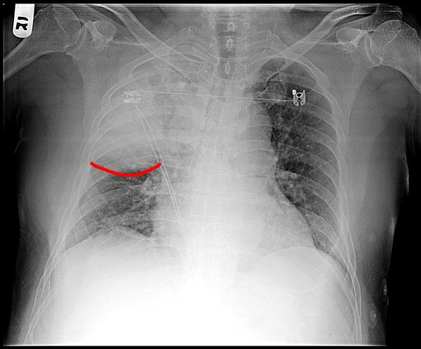 Medical Addicts: Chest X-ray: The bulging fissure sign