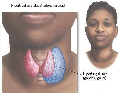 TIROTOKSIKOSIS / KELEBIHAN HORMON TIROID