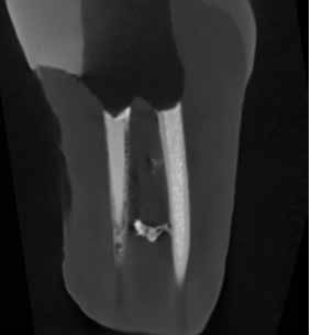 Dentistry and Medicine: Purpose of Root Canal Obturation and method of ...
