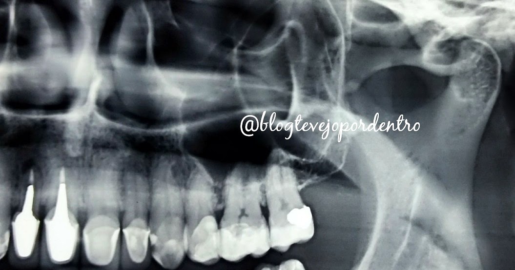 "Te vejo por dentro": Resto mortal do dente 38...