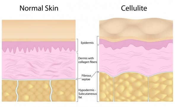 Anti Cellulite Removal: The UNTOLD Secret - How Cellulite Forms In The ...