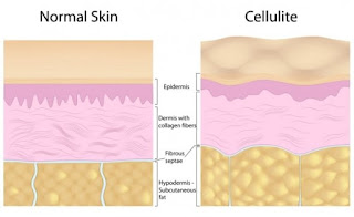 Anti Cellulite Removal: The UNTOLD Secret - How Cellulite Forms In The ...