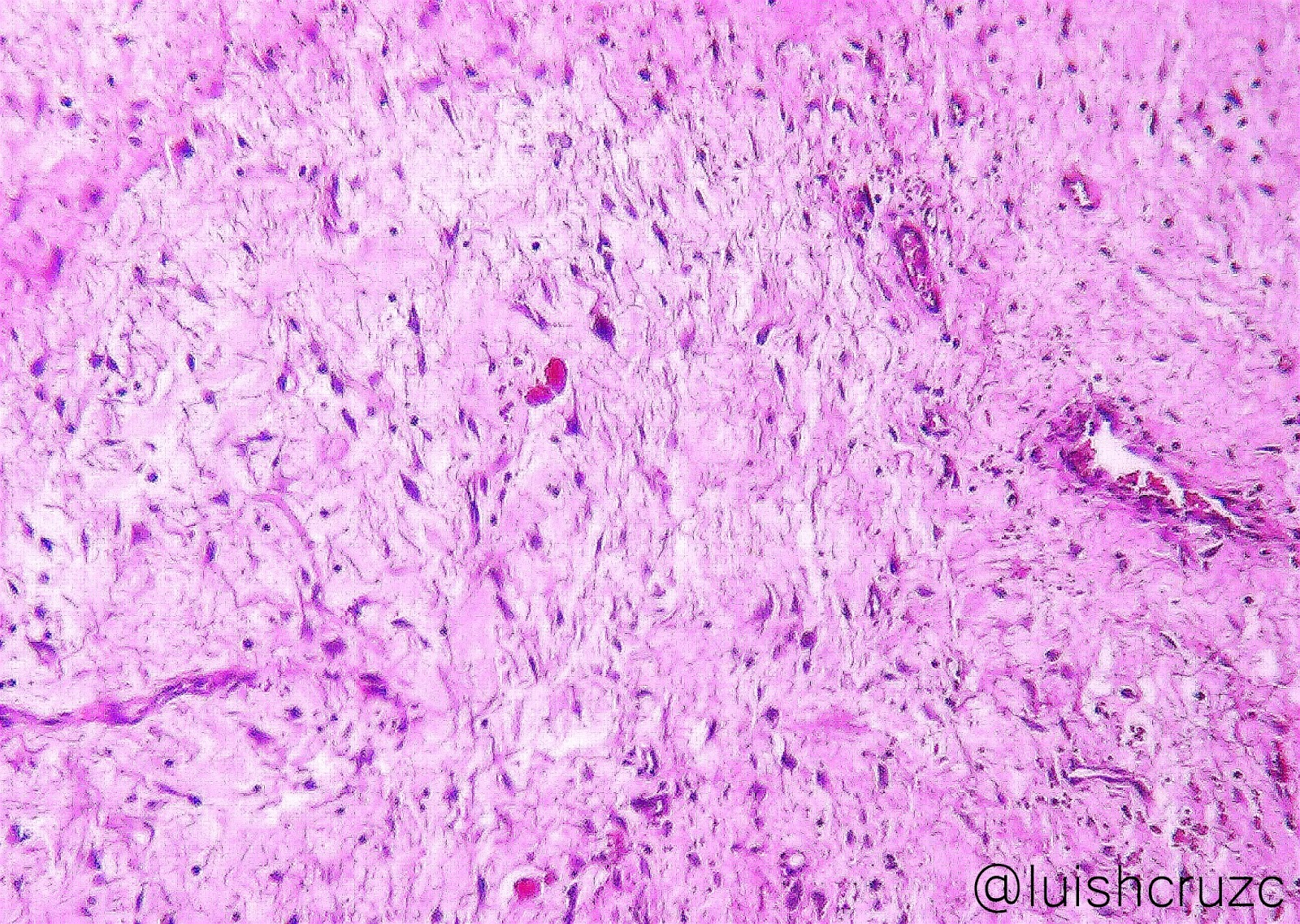 Patología CC: Angiomixoma profundo (agresivo)