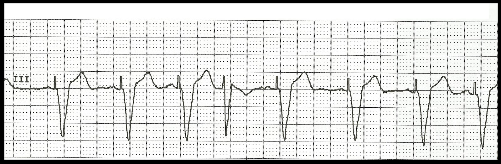 Basic EKG Rhythm Test 04
