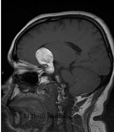 El Baúl Radiológico: 2) QUISTE DERMOIDE INTRACRANEAL (Intracranial ...