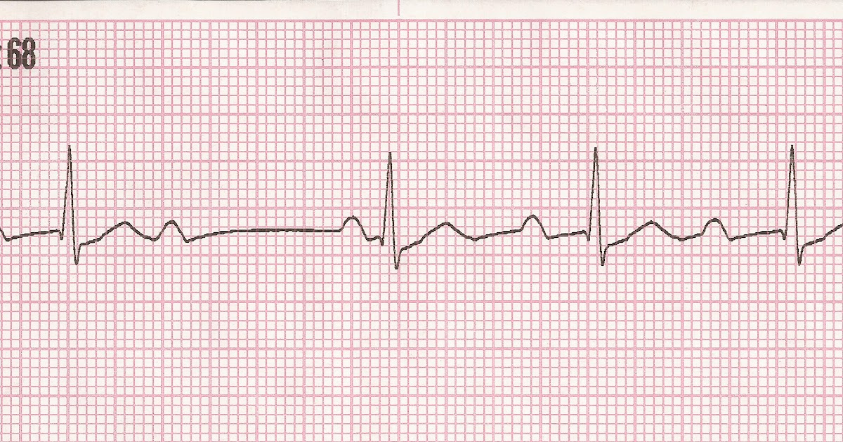 EKG Rhythm Strips 01
