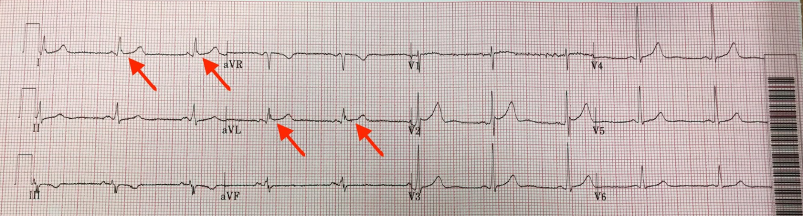 Dr. Smith's ECG Blog: ST Elevation in I and aVL: do prehospital cath ...