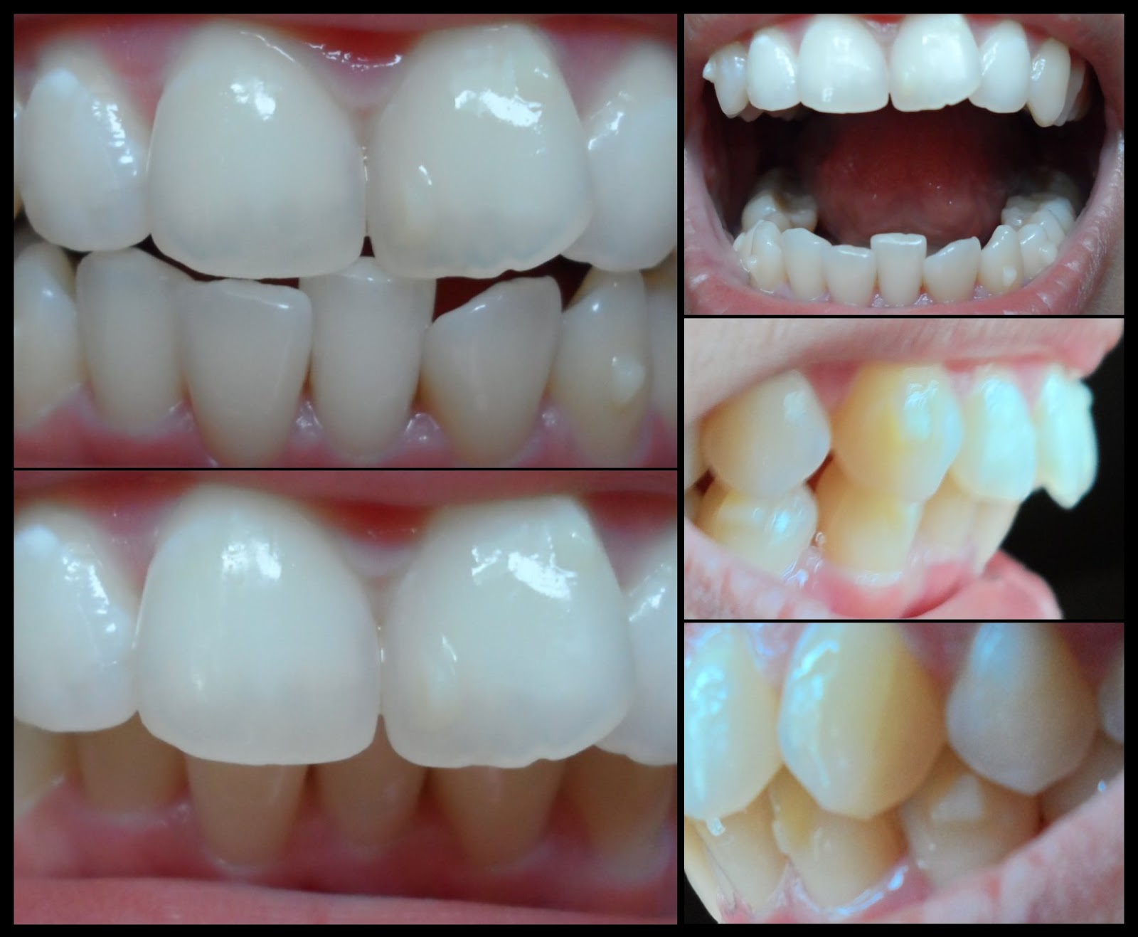 Ana's Invisalign Journey: Tray 4 & 5