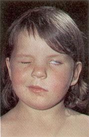 Pediatría Basada en Pruebas: ¿Cuál es el mejor tratamiento de la ...