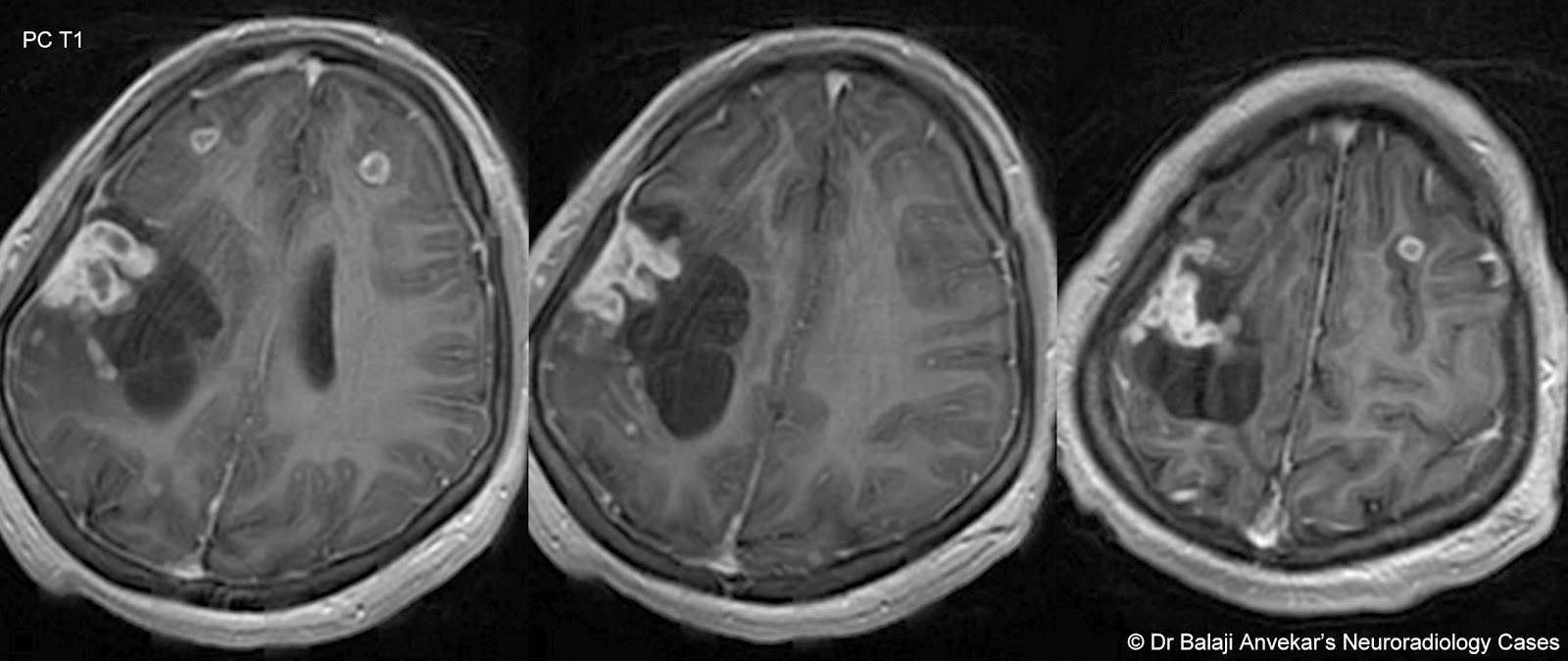 Dr Balaji Anvekar FRCR: Tuberculoma with associated Subdural Meningeal Cyst