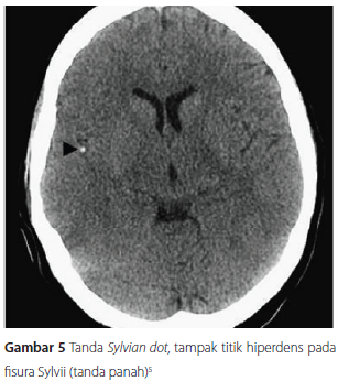 ilmu kedokteran: Stroke Iskemik dan Gambaran Ct Scan