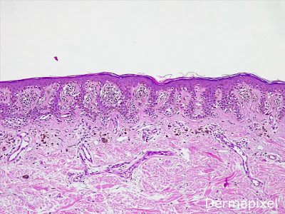 Dermapixel: Nevus displásico: ¿El bueno, el feo o el malo?