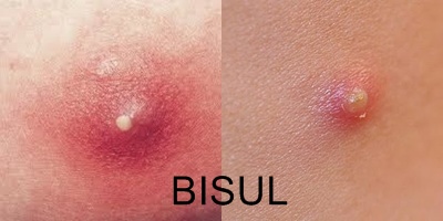 Artikel Kesehatan: Jenis Bisul Yang Membahayakan