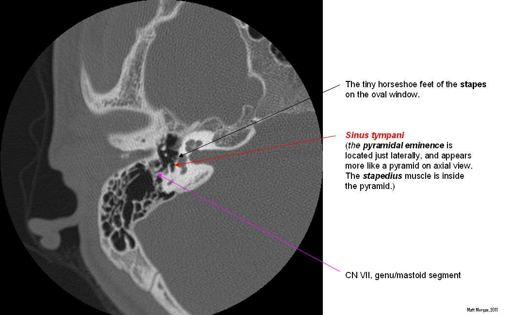 Pyramidal Eminence Ct
