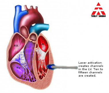 4 JENIS PEMBEDAHAN JANTUNG ANDA PERLU TAHU! | Tasly Danshen Plus Lulus ...