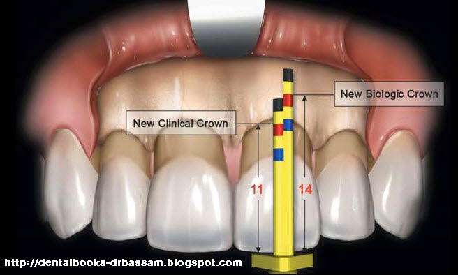 A BIOMETRIC APPROACH TO AESTHETIC CROWN LENGTHENING | EURO DENTIST